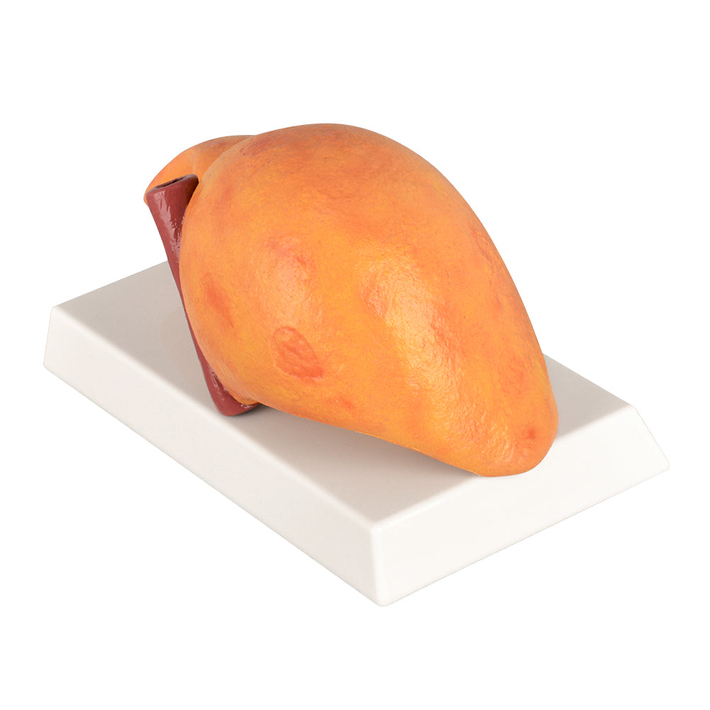 3D Liver Model with Alcoholic Fatty – Medarchitect