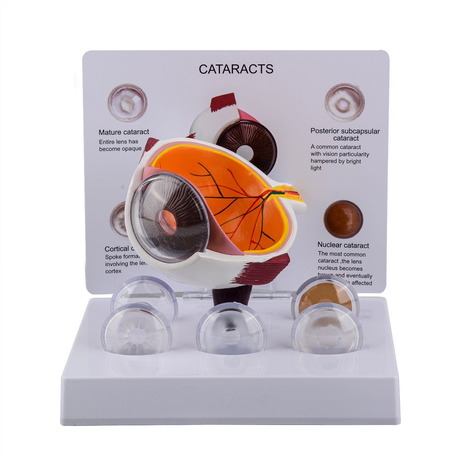 Anatomical Eye Model with Cataract – Medarchitect