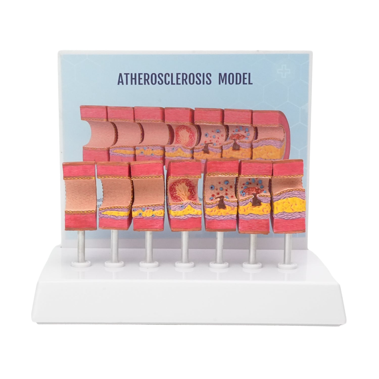 Atherosclerosis Model with 7 Arterial Lesion Stages – Medarchitect