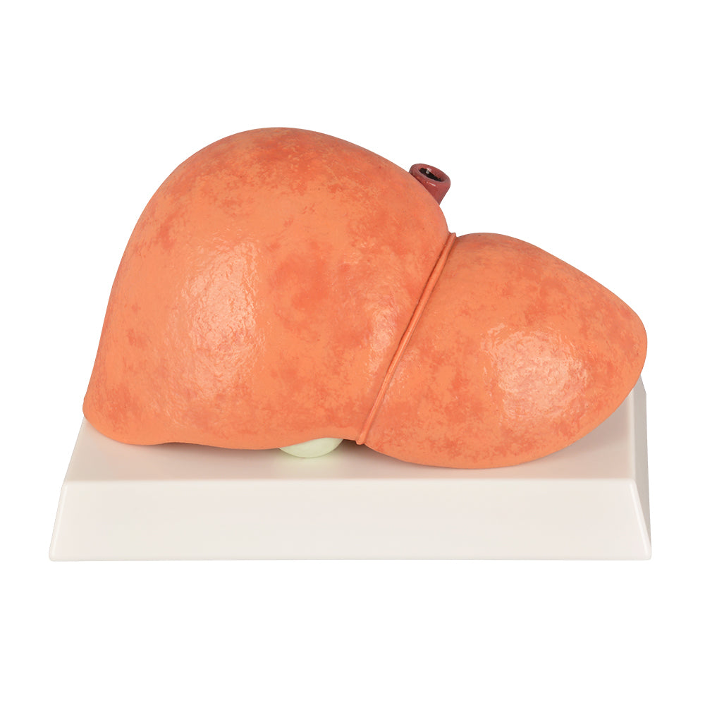 Liver Anatomical Model, Non-Alcoholic Fatty – Medarchitect