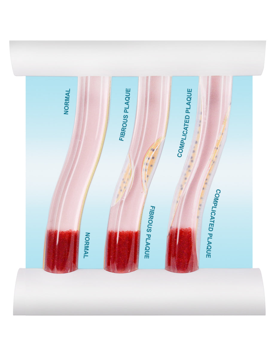 Low-Density Lipoprotein LDL Blood Vessel Model for Medical Patient Doc ...
